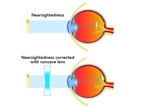 How do glasses correct nearsightedness?